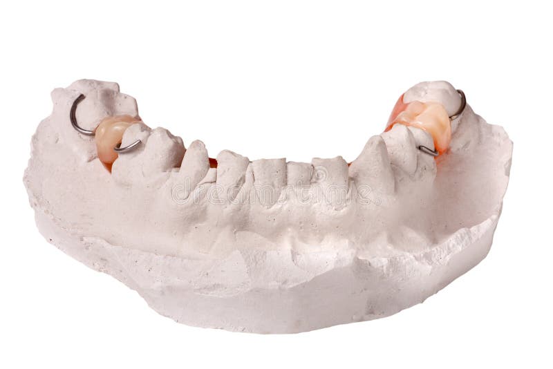 Plaster Cast of Teeth with Removable Partial Denture Isolated on White ...