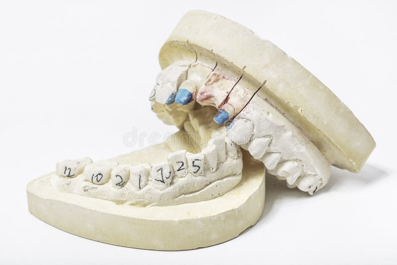 Plaster Cast of Teeth on White Stock Photo - Image of blue, gypsum ...