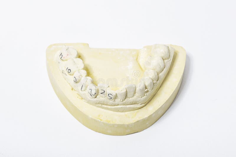 Plaster Cast of Teeth on White Stock Image - Image of gypsum, dental ...