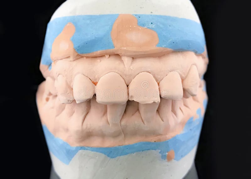 Plaster Casting Model on Black Background. Close Up Dental Plaster ...