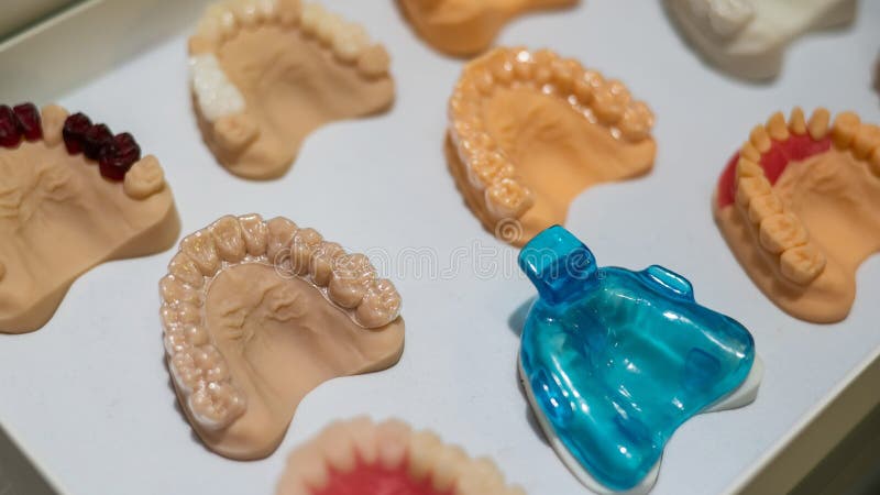 Plaster Casts of the Jaws. Variety of Samples in the Prosthetic ...