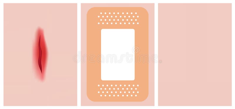 Plaster cure a wound stock illustration. Illustration of plaster - 70612108