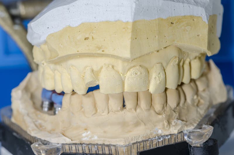 Plaster dental mold. stock image. Image of endodontics - 65074697