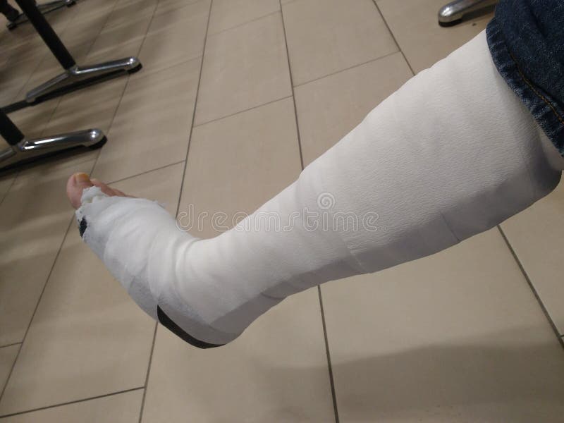 Plaster feet stock image. Image of feet, plaster, operation - 90568885