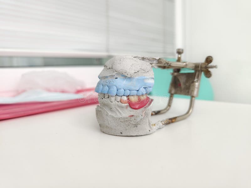 Plaster Model with Artificial Teeth for Making a Denture Stock Image ...