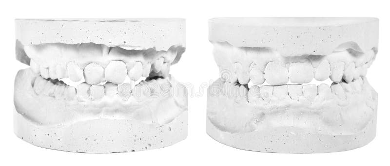 Plaster Model before and after a Brace Stock Image - Image of dentition ...