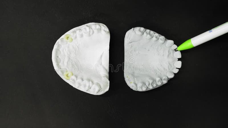 Plaster Model or Cast of Human Teeth. Stock Footage - Video of casting ...