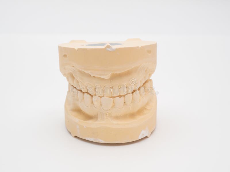 Plaster Model or Cast of Human Teeth. Stock Image - Image of oral ...