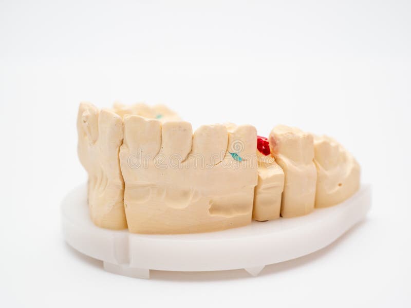 Plaster Model or Cast of Human Teeth. Stock Image - Image of equipment ...