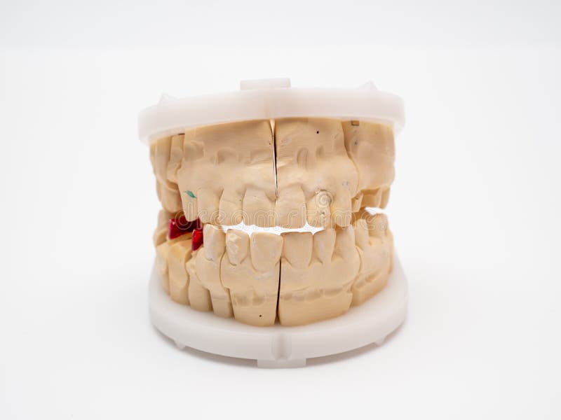 Plaster Model or Cast of Human Teeth. Stock Image - Image of cast ...