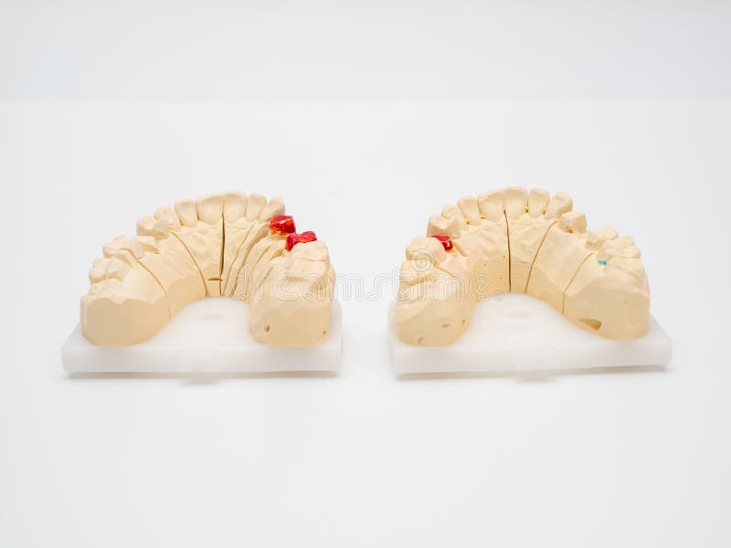 Plaster Model or Cast of Human Teeth. Stock Image - Image of equipment ...
