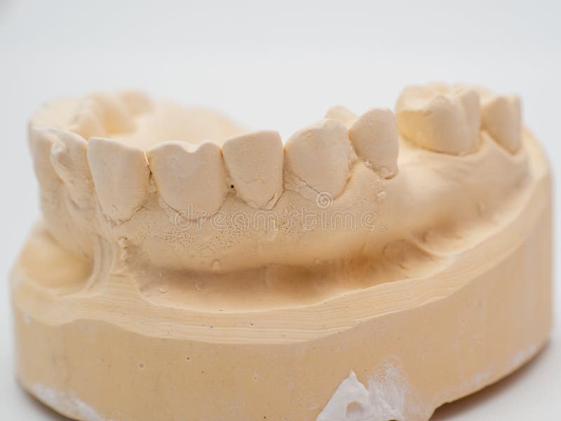 Plaster Model or Cast of Human Teeth. Stock Photo - Image of prosthesis ...