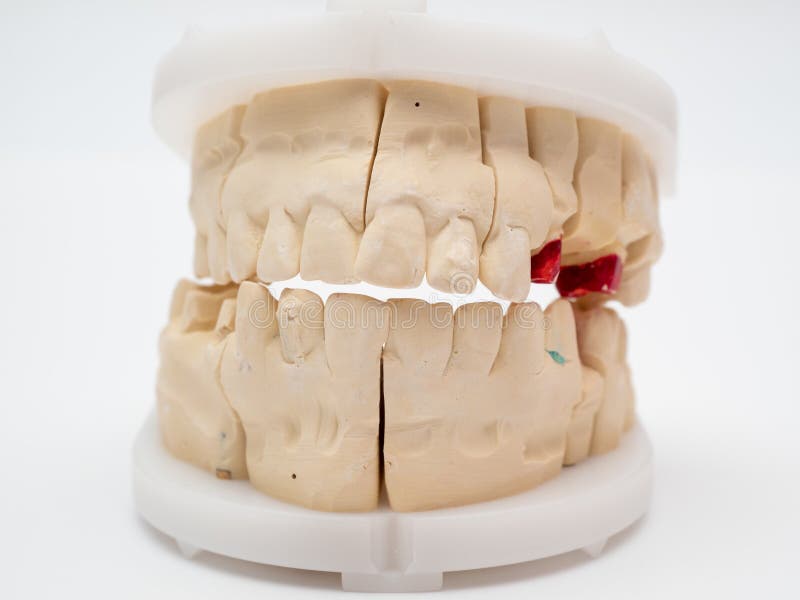 Plaster Model or Cast of Human Teeth. Stock Photo - Image of dental ...