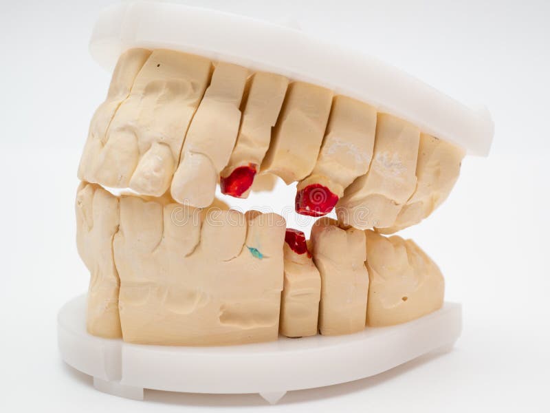 Plaster Model or Cast of Human Teeth. Stock Image - Image of human ...