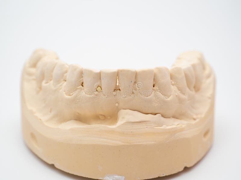 Plaster Model or Cast of Human Teeth. Stock Photo - Image of crown ...