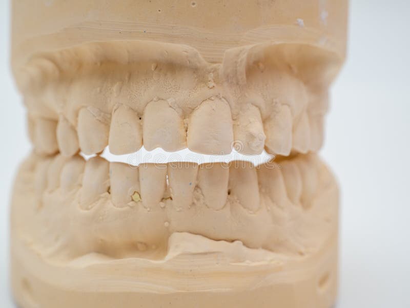 Plaster Model or Cast of Human Teeth. Stock Photo - Image of denture ...