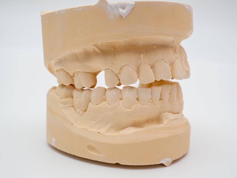 Plaster Model or Cast of Human Teeth. Stock Image - Image of medicine ...