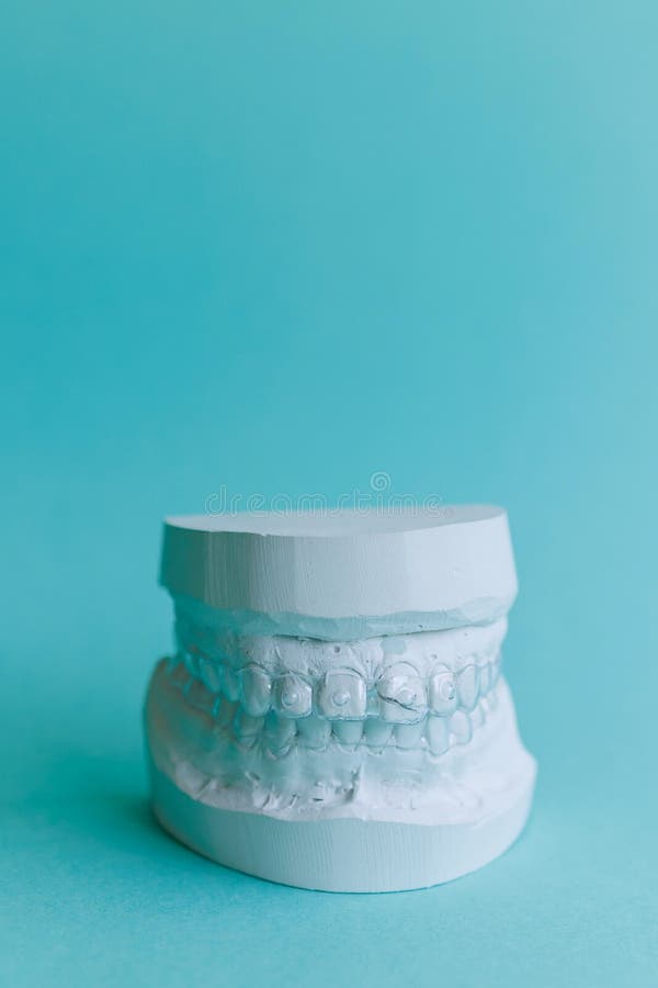 Plaster Model of Human Teeth with Transparent Aligner, Essix Retainer ...