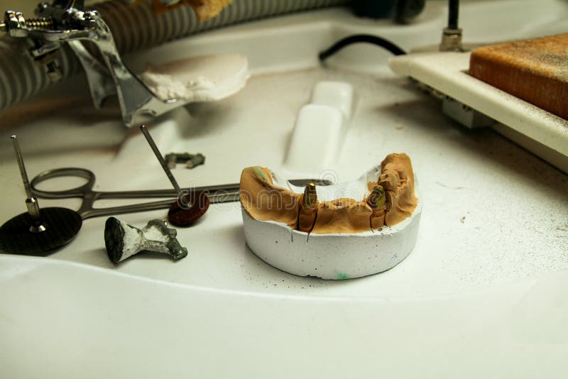 The Plaster Model of the Jaws with Tools Stock Photo - Image of ...