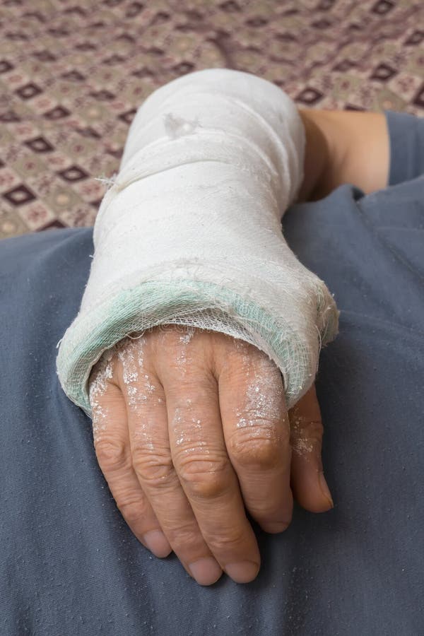 Plastered Hand Holding Something Stock Photo - Image of hospital ...