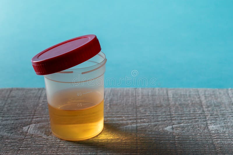 Plastic Container with Urine Analysis on a White Background Stock Image ...