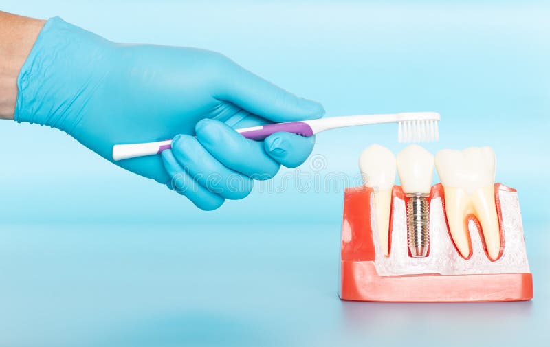 Plastic Samples of Dental Implants Compare with Natural Teeth Stock ...