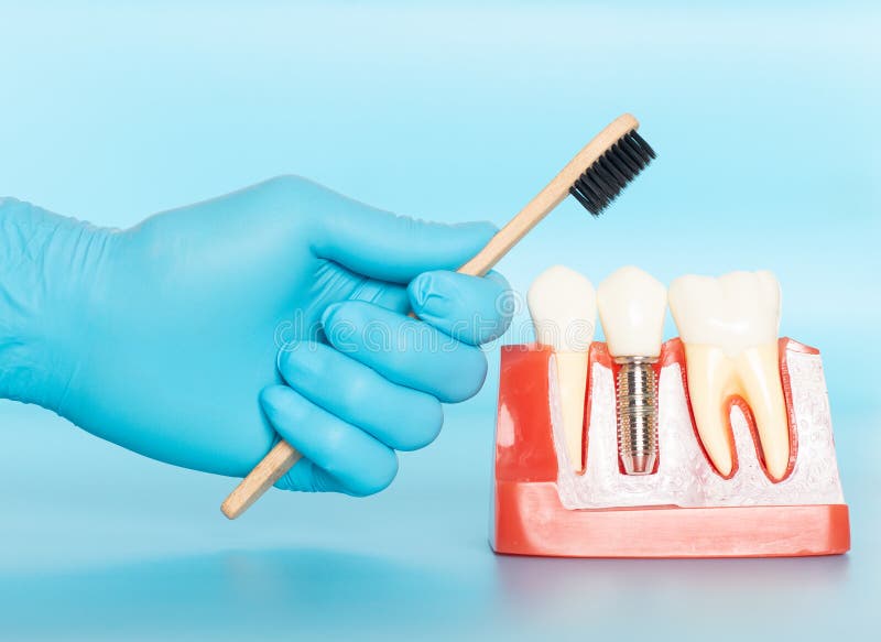 Plastic Samples of Dental Implants Compare with Natural Teeth Stock ...