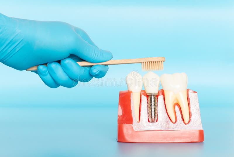 Plastic Samples of Dental Implants Compare with Natural Teeth Stock ...