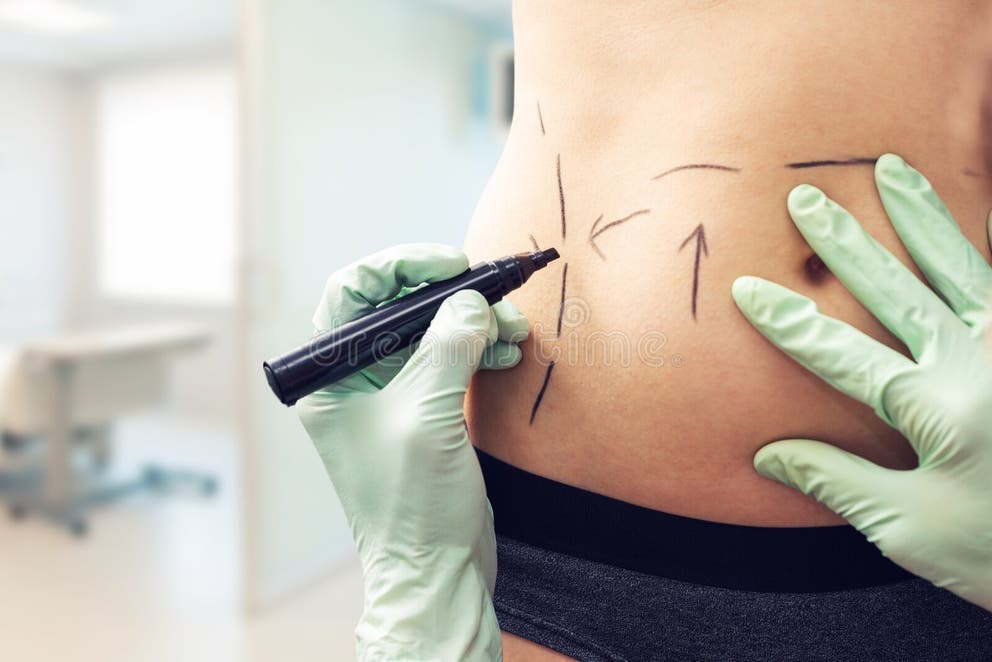 Plastic Surgeon Marking Womans Body for Surgery Stock Photo - Image of ...