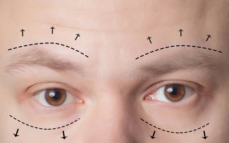 Eyelids Plastic Surgery Concept - Asian Monolids Stock Photo - Image of ...