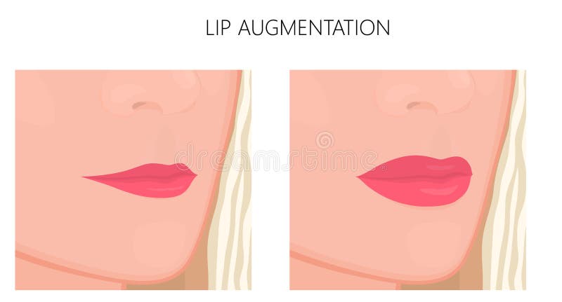 Lip augmentation stock vector. Illustration of procedure - 244237881