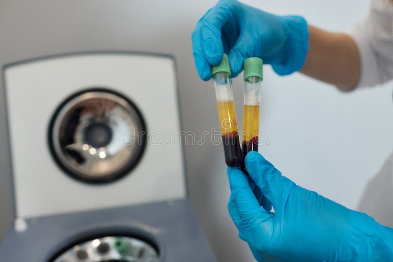 Platelet-Rich Plasma Preparation. Plasma in Syringe. Centrifuge. Stock ...