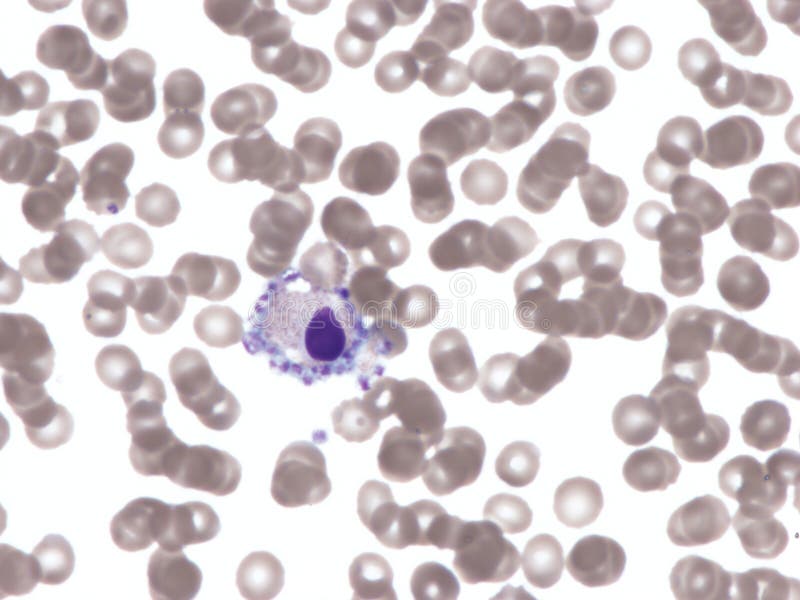 Platelet Satellitism. Peripheral Blood. Stock Image - Image of ...