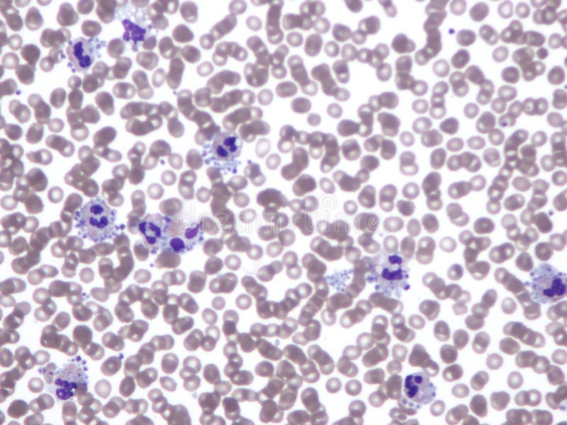 Platelet Satellitism. Peripheral Blood. Stock Image - Image of edta ...