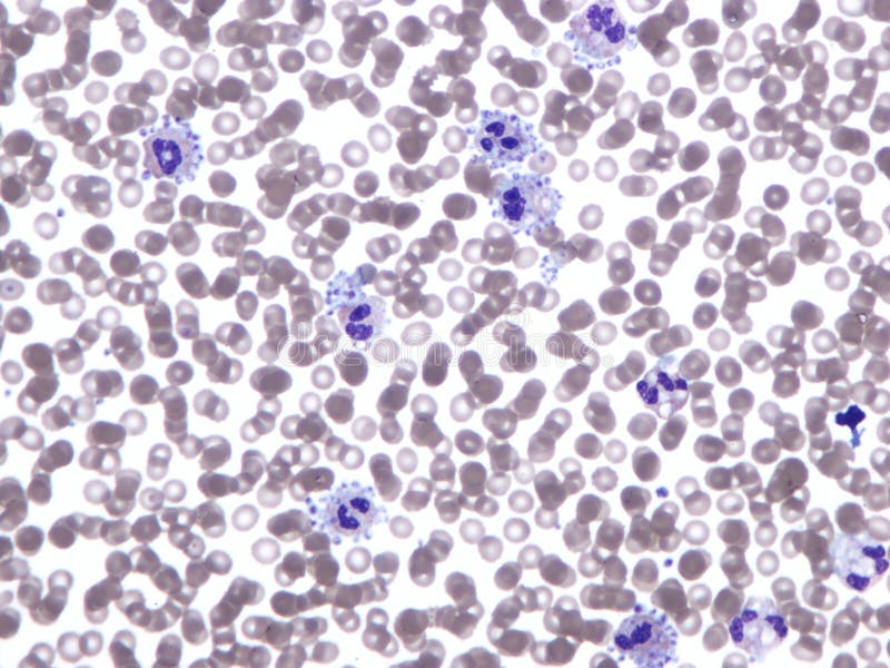 Platelet Satellitism. Peripheral Blood. Stock Photo - Image of samples ...