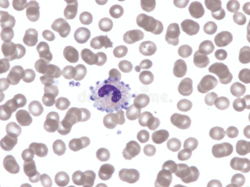 Platelet Satellitism. Peripheral Blood. Stock Photo - Image of rare ...