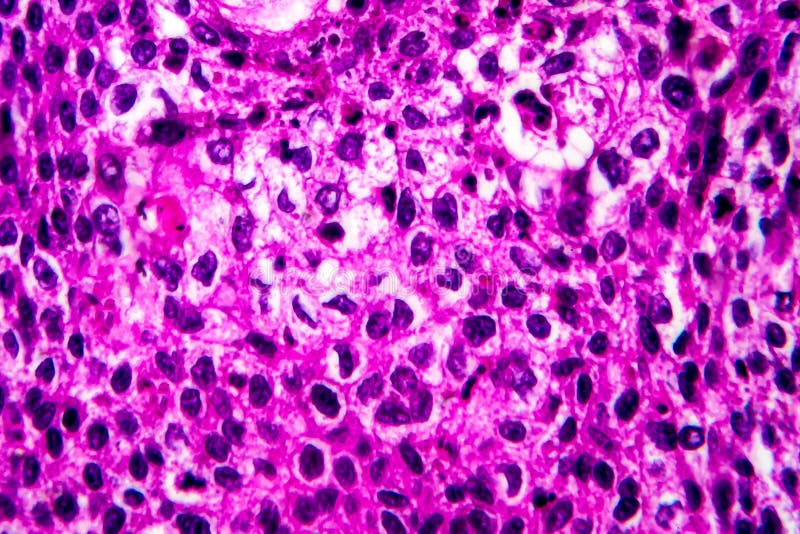 Plaveiselcelcarcinoom Van De Uterus Lichtmicrograaf Stock Foto - Image ...