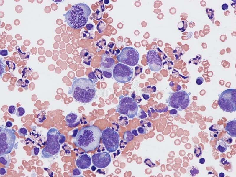 B-cell Lymphoma in Pleural Fluid Stock Photo - Image of fluid, tumor ...