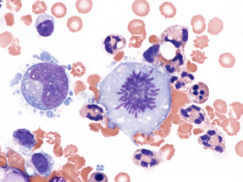 Pleural Lymphoma, Cytology. Stock Image - Image of hematology ...