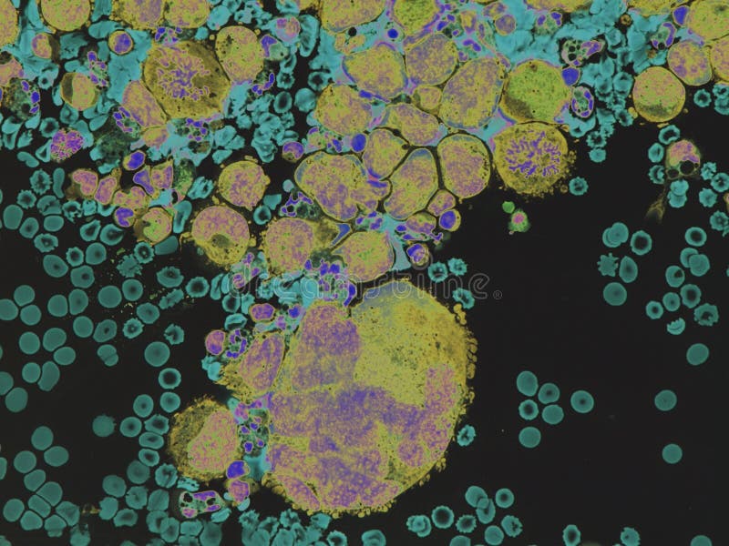 Pleural Lymphoma, Cytology. Stock Photo - Image of lymphoma, large ...