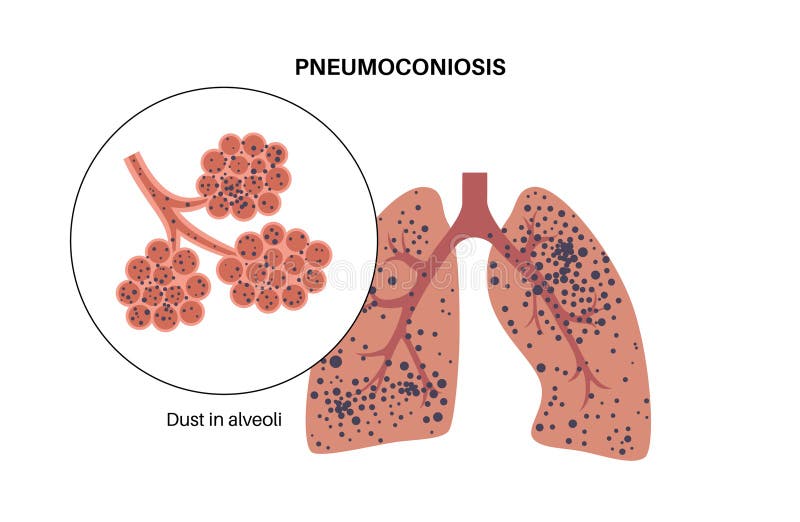 Asbestosis lung disease stock illustration. Illustration of medical ...