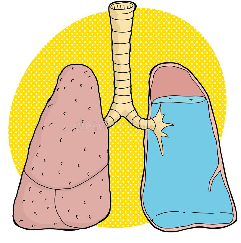 Pneumonia Illustration stock vector. Illustration of inside - 45147322