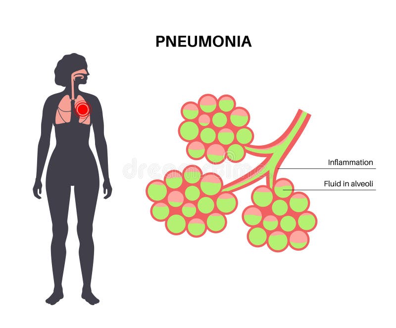 Pneumonia infection poster stock vector. Illustration of care - 273779483