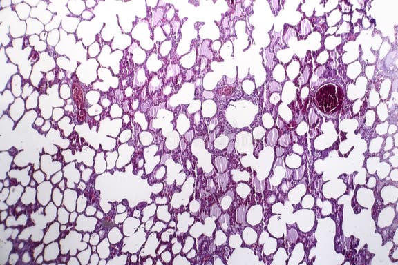 Pneumonia, Light Micrograph Stock Photo - Image of bacterial, cellulose ...