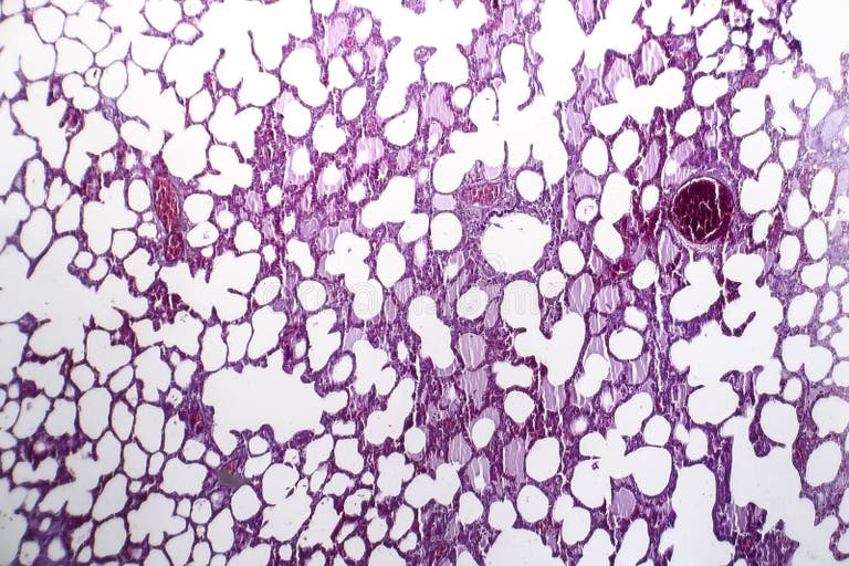 Pneumonia, Light Micrograph Stock Photo - Image of bacterial, cellulose ...