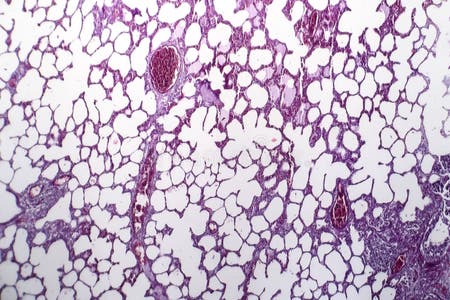 Pneumonia, Light Micrograph Stock Image - Image of micrograph, microbe ...