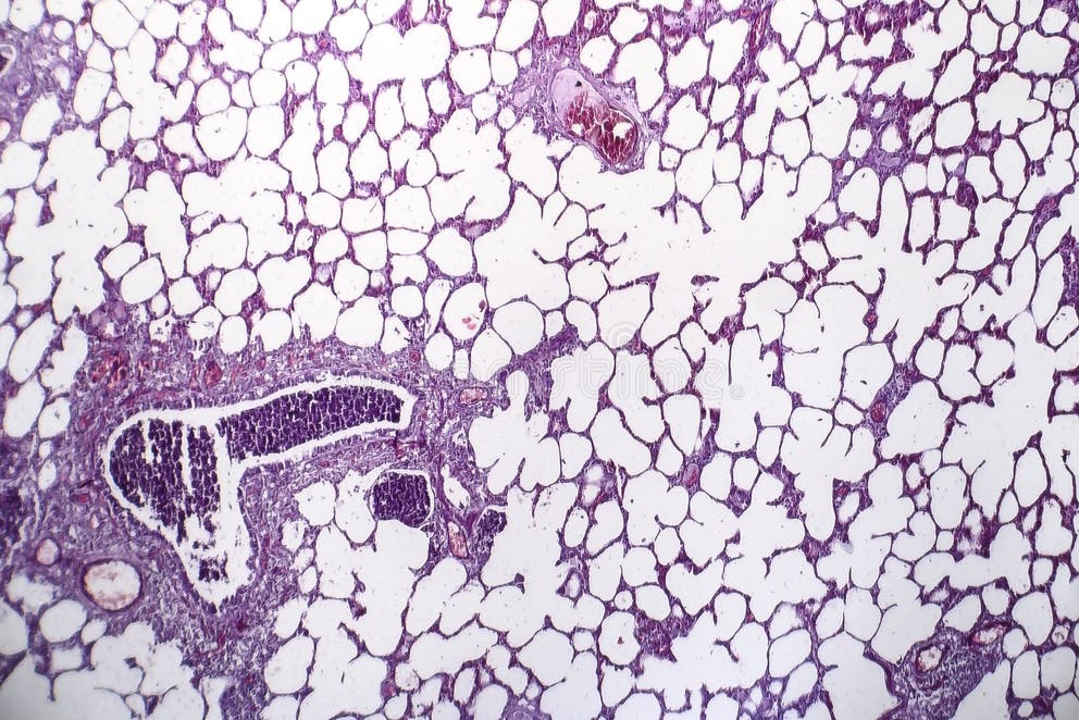 Pneumonia, Light Micrograph Stock Image - Image of bacterial ...