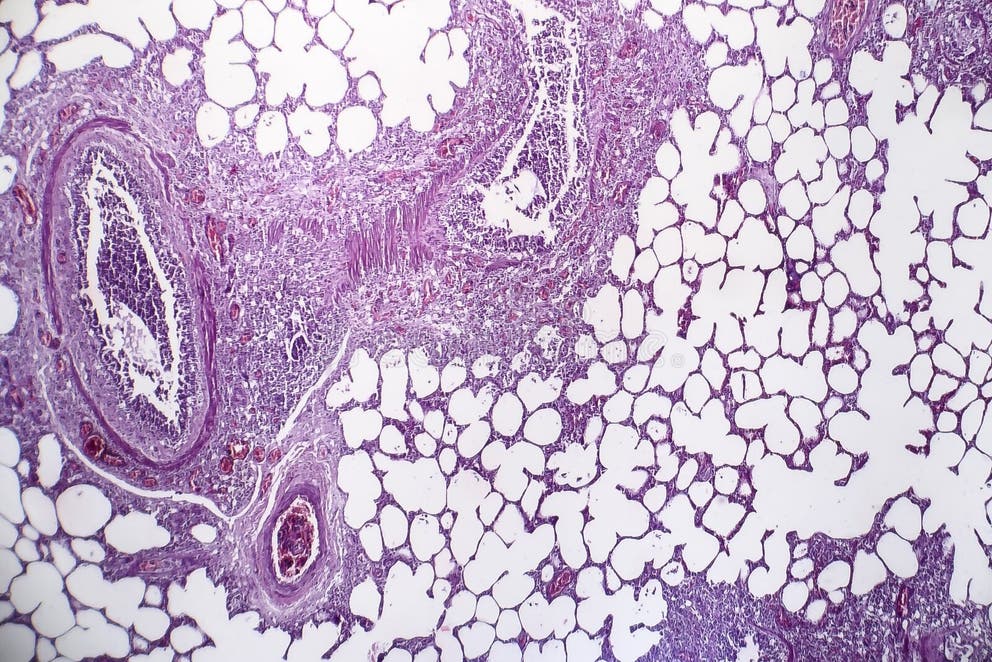 Pneumonia, Light Micrograph Stock Image - Image of cell, lung: 141005179