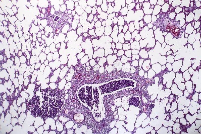 Pneumonia, Light Micrograph Stock Photo - Image of microorganism ...