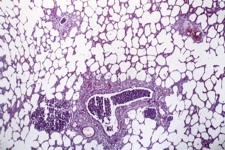 Pneumonia, Light Micrograph Stock Photo - Image of microorganism ...